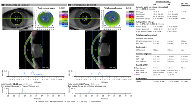 Biométrie oculaire – Cabinet d'Ophtalmologie de Moorea
