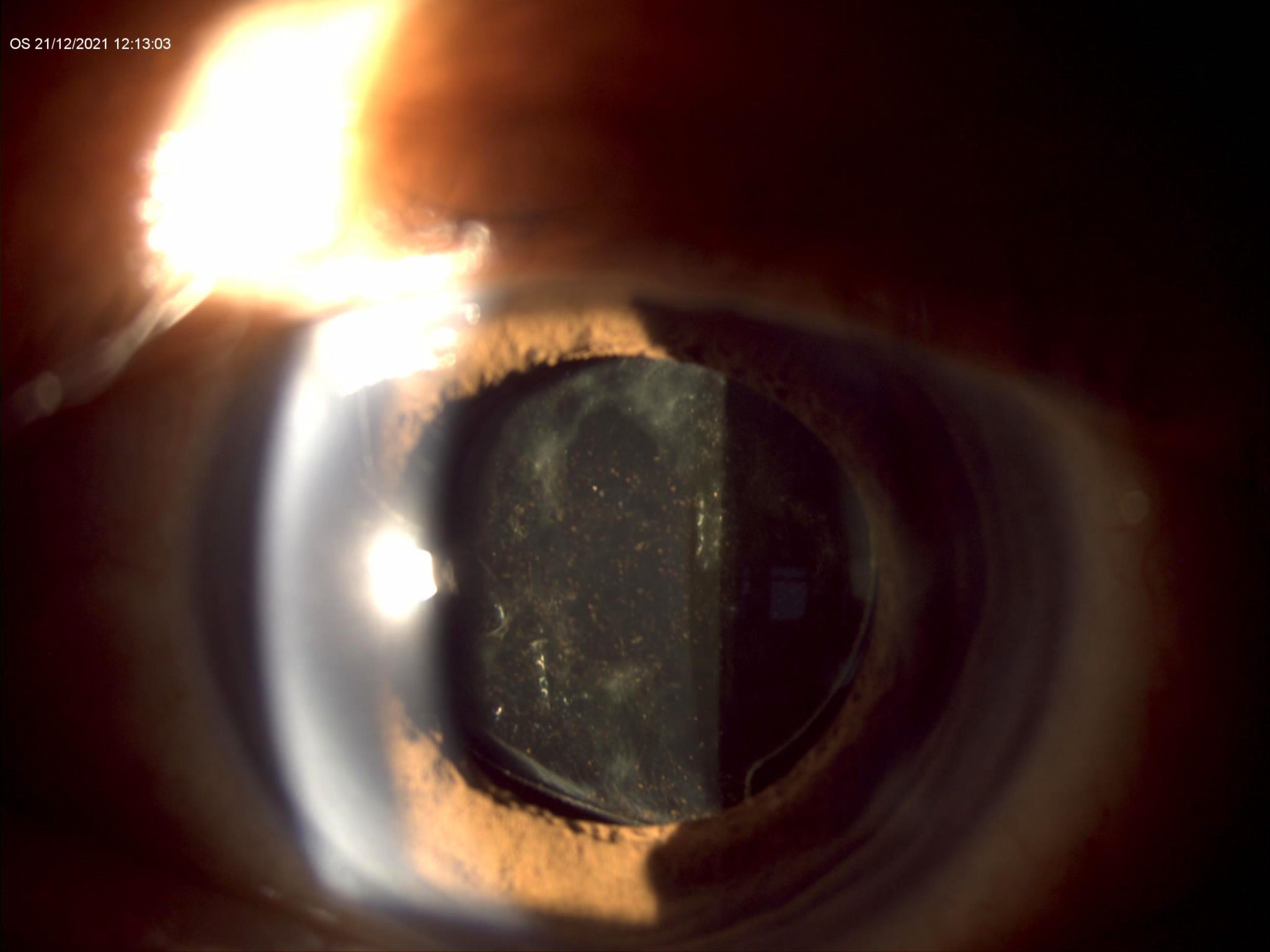 Capsulotomie au laser YAG – Cabinet d'Ophtalmologie de Moorea